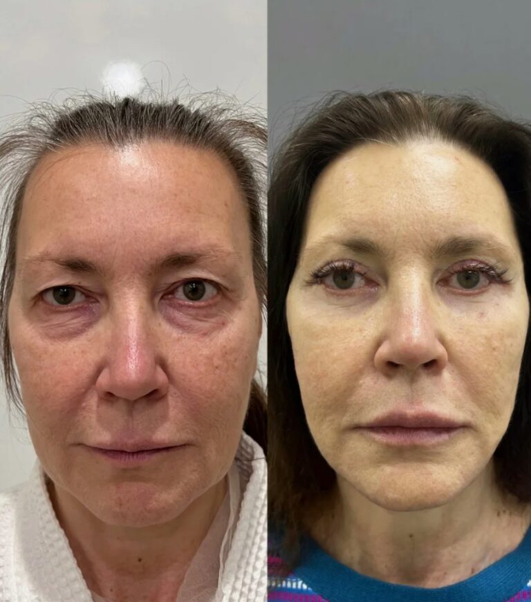 Salmon DNA Injection Treatments London Cost £250 before & after