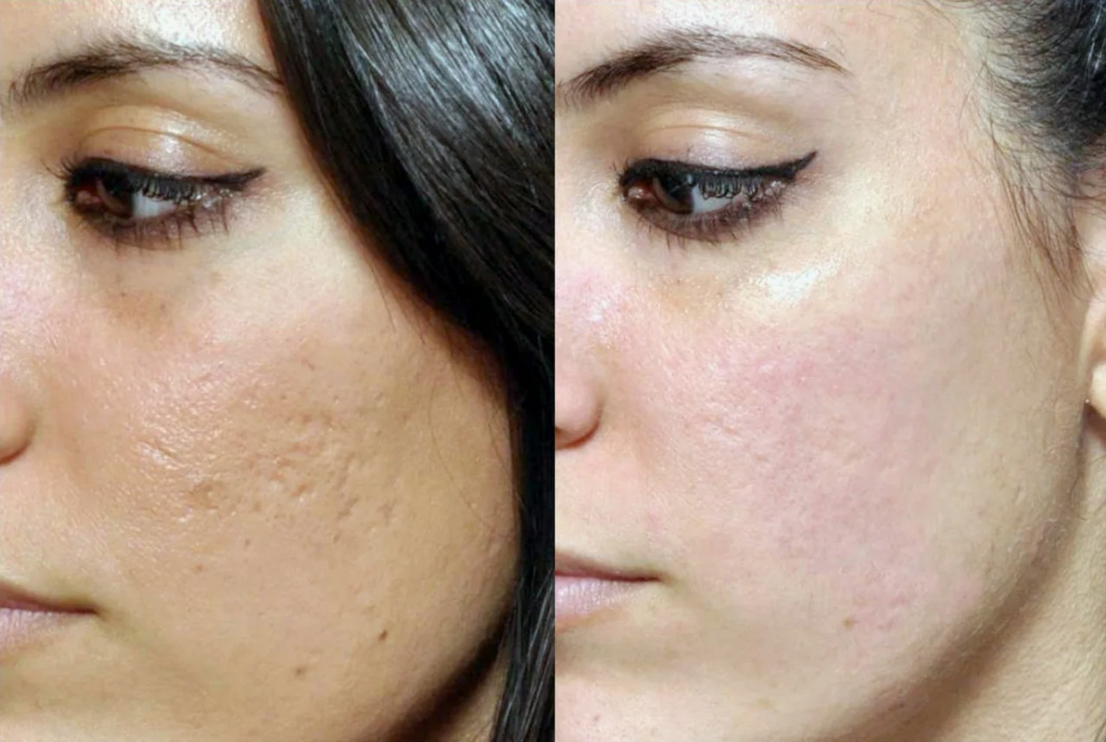 SkinPen Microneedling⚕️London Cost £200 before & after