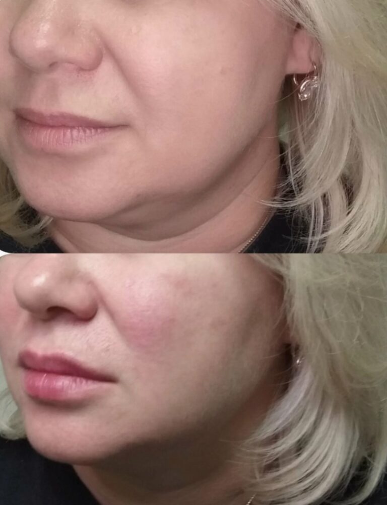 Bellafill Filler in London⚕️Price £450-850 before and after