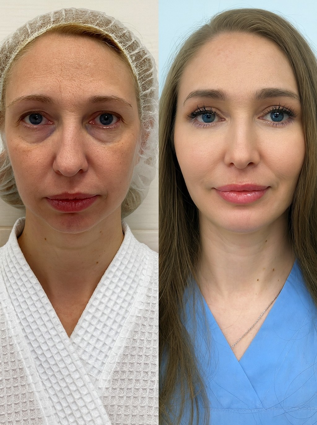 Dermal Fillers London Clinic Full Face Filler Price £890 before & after