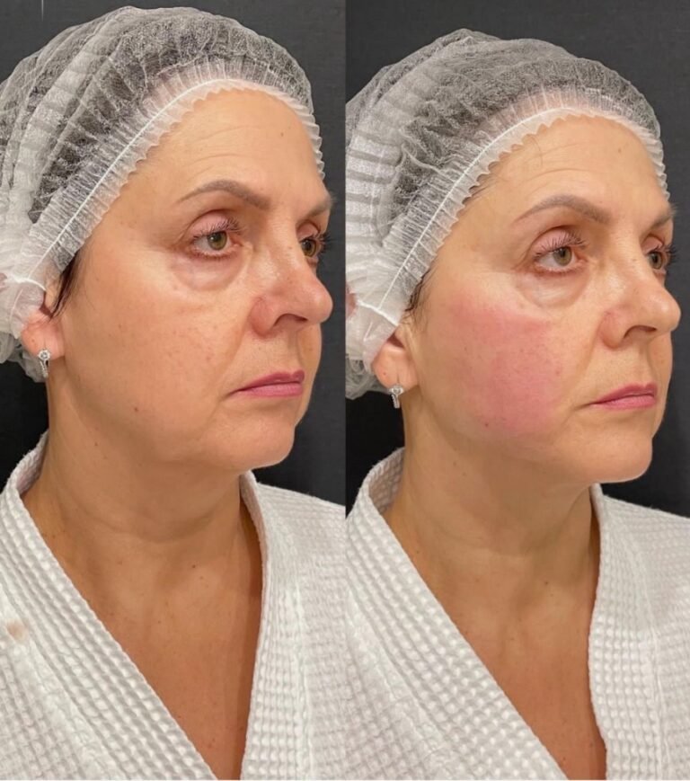 Sculptra Treatment⚕️London cost £650 before & after