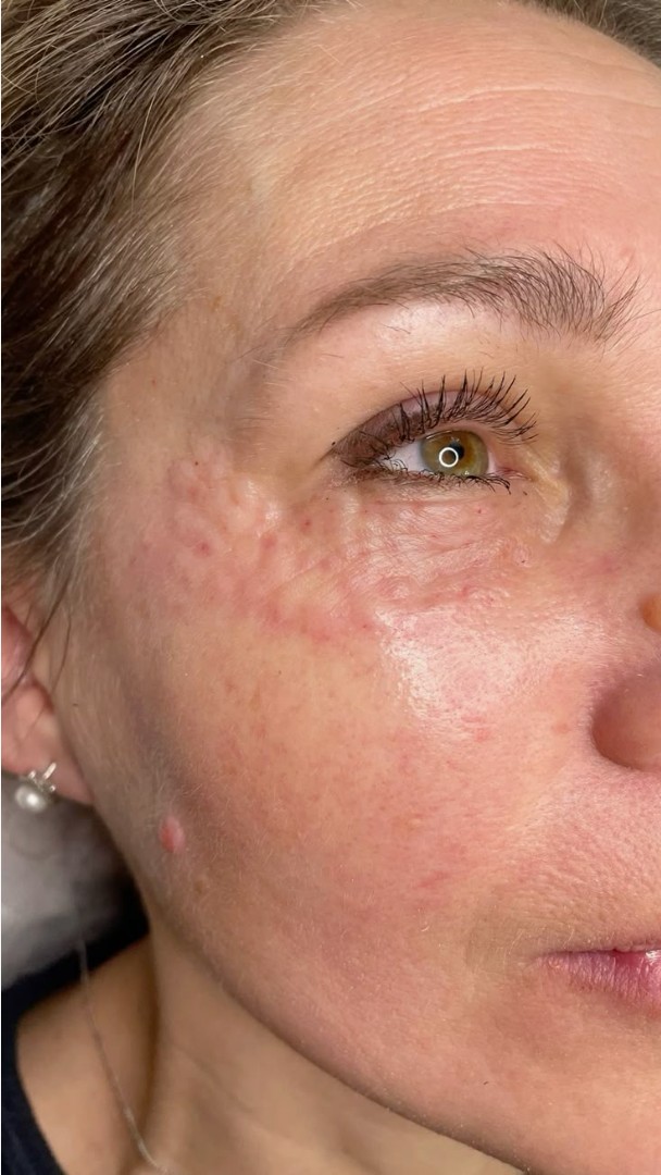 SkinPen Microneedling⚕️London Cost £200 before & after