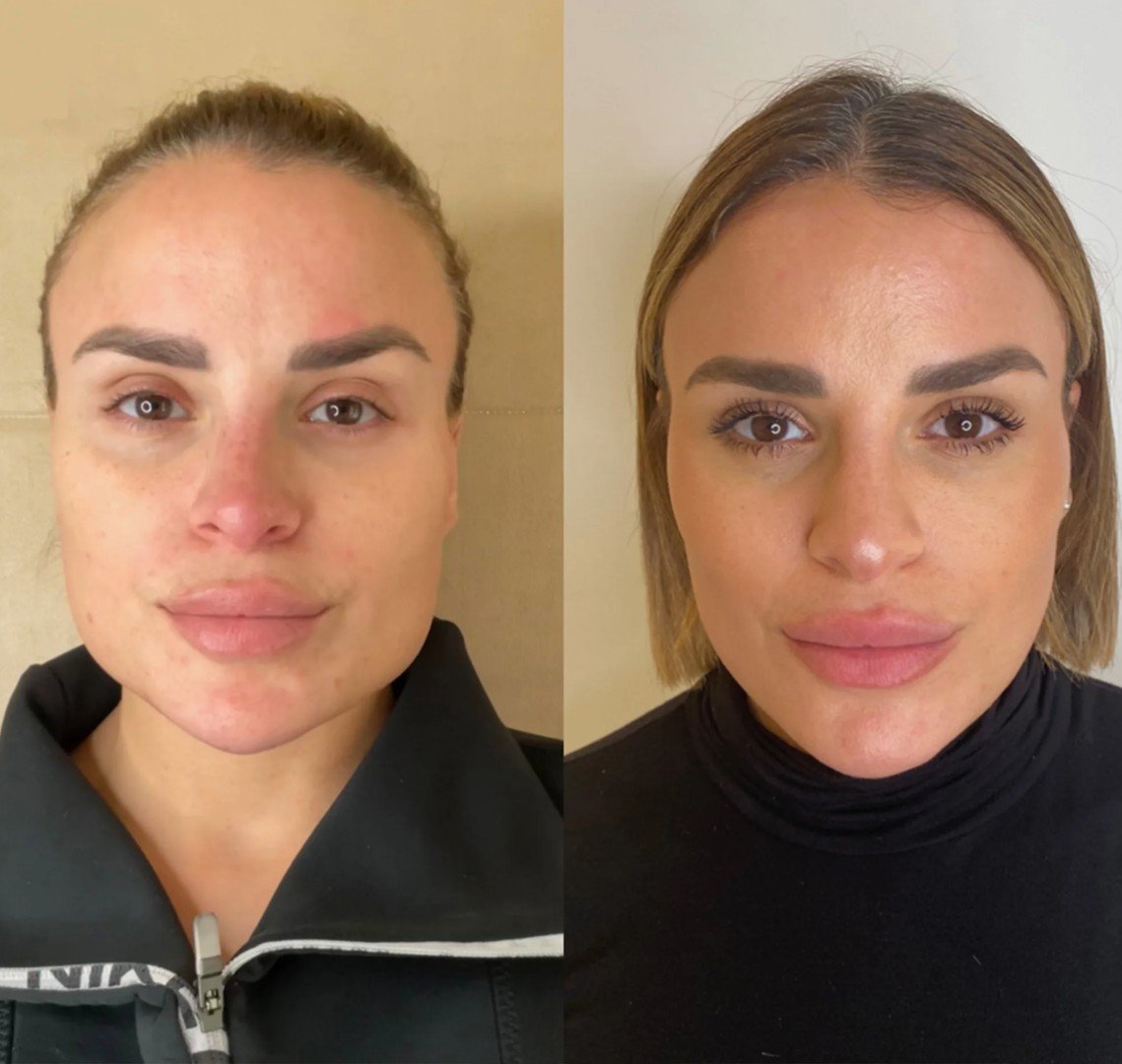 Botox for TMJ and Bruxism Treatments ⚕️ London cost £350