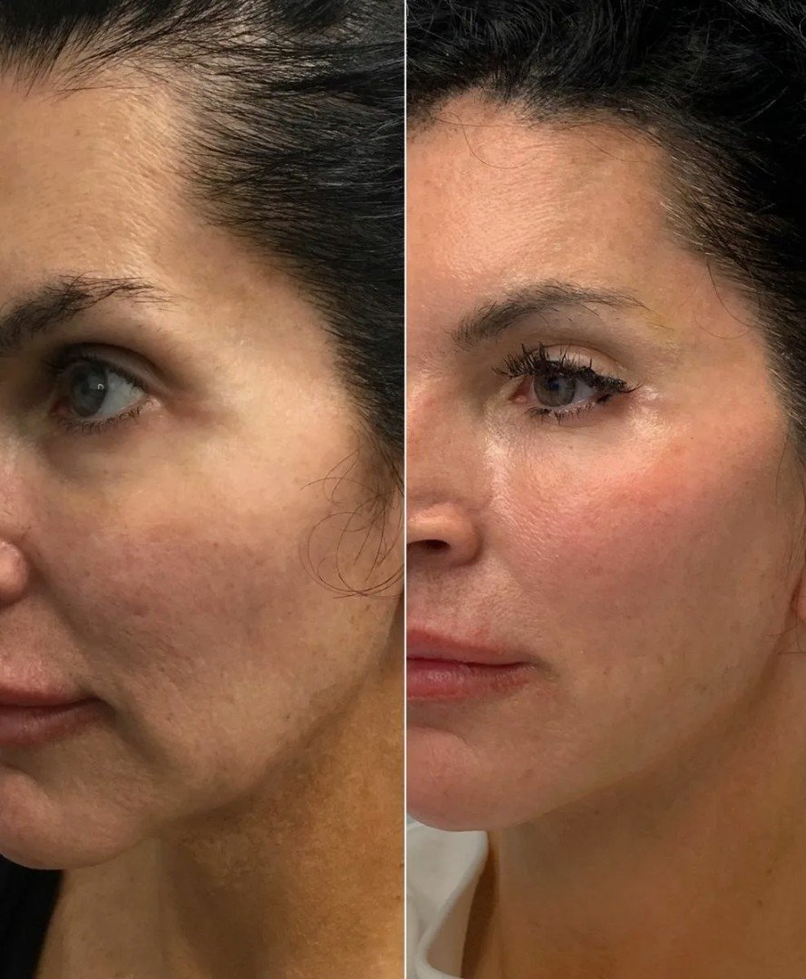 Sculptra Treatment⚕️London cost £650 before & after